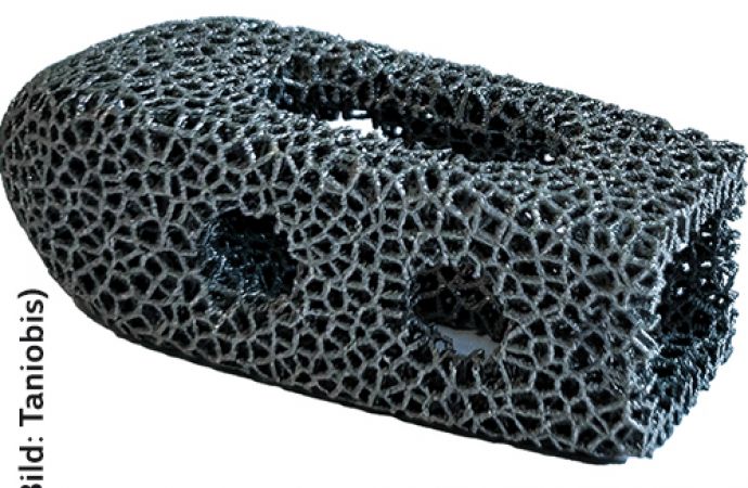 Tantal und Niob revolutionieren den 3D-Druck von Implantaten in der ...